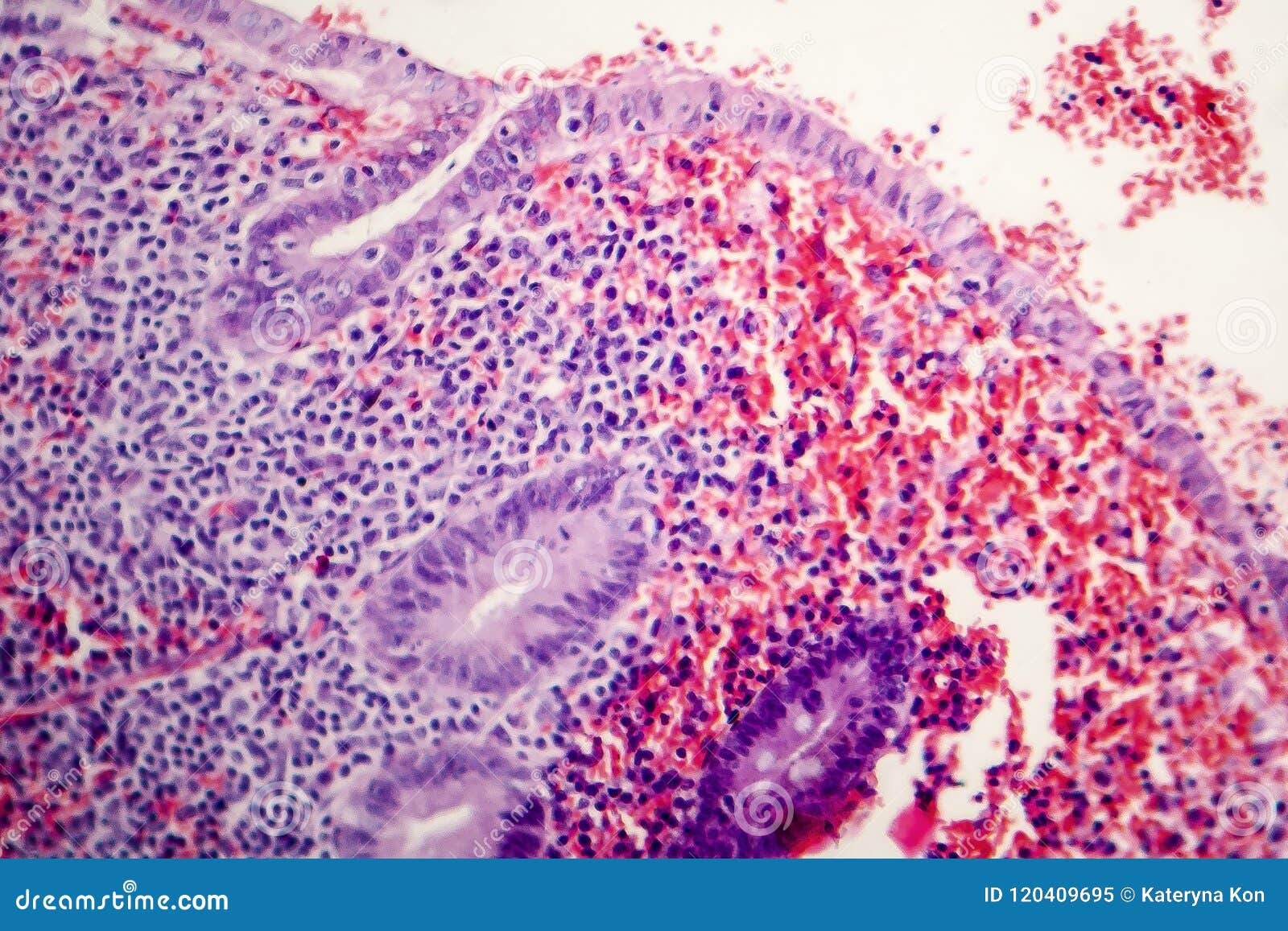 Histopathology of Chronic Appendicitis Stock Image - Image of ...