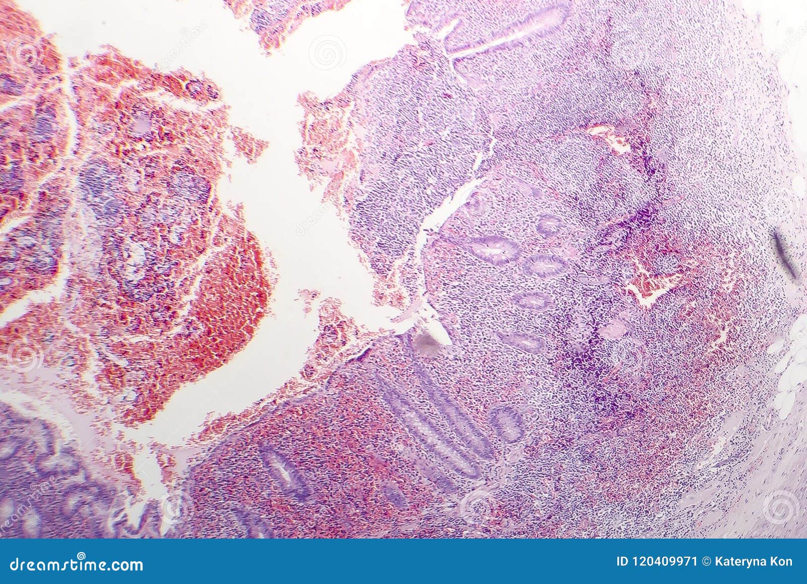 Histopathology of Chronic Appendicitis Stock Image - Image of ...