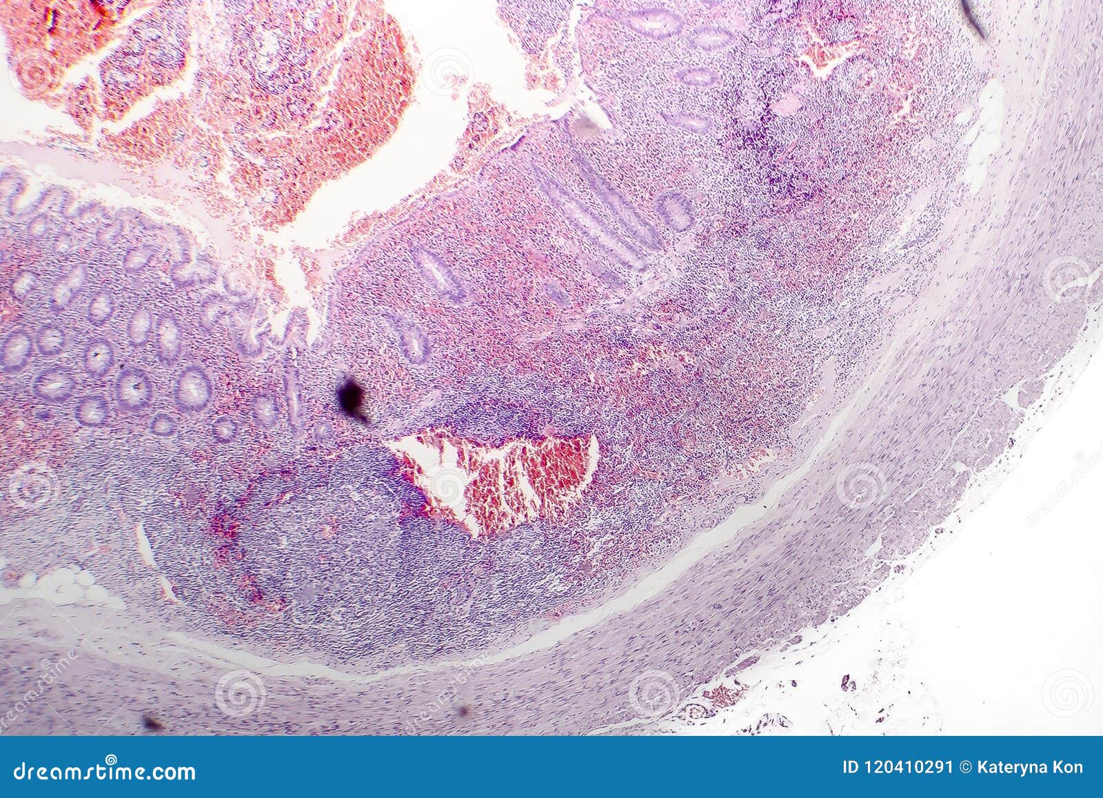 Histopathology of Chronic Appendicitis Stock Image - Image of ...