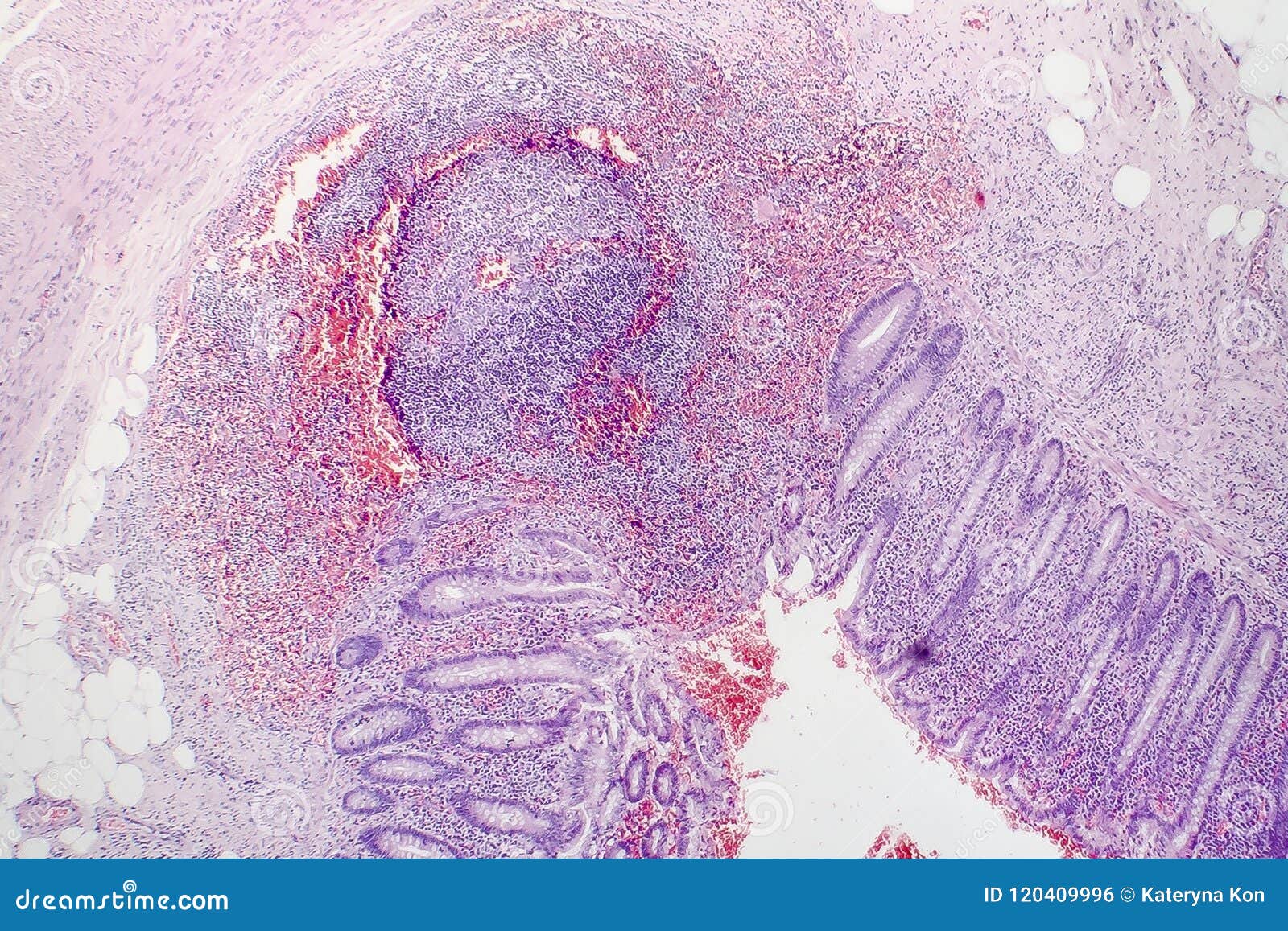 Appendicitis Histology