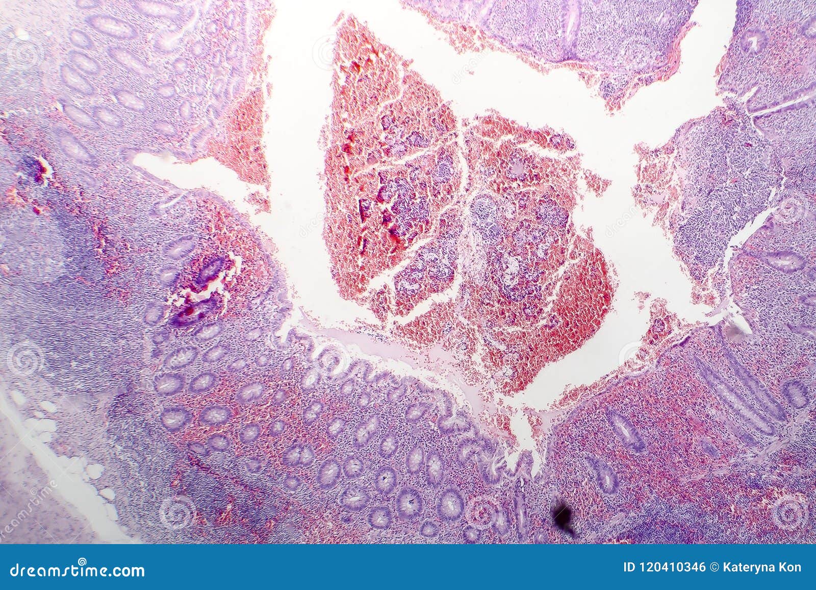 Histopathology of Chronic Appendicitis Stock Photo - Image of ...