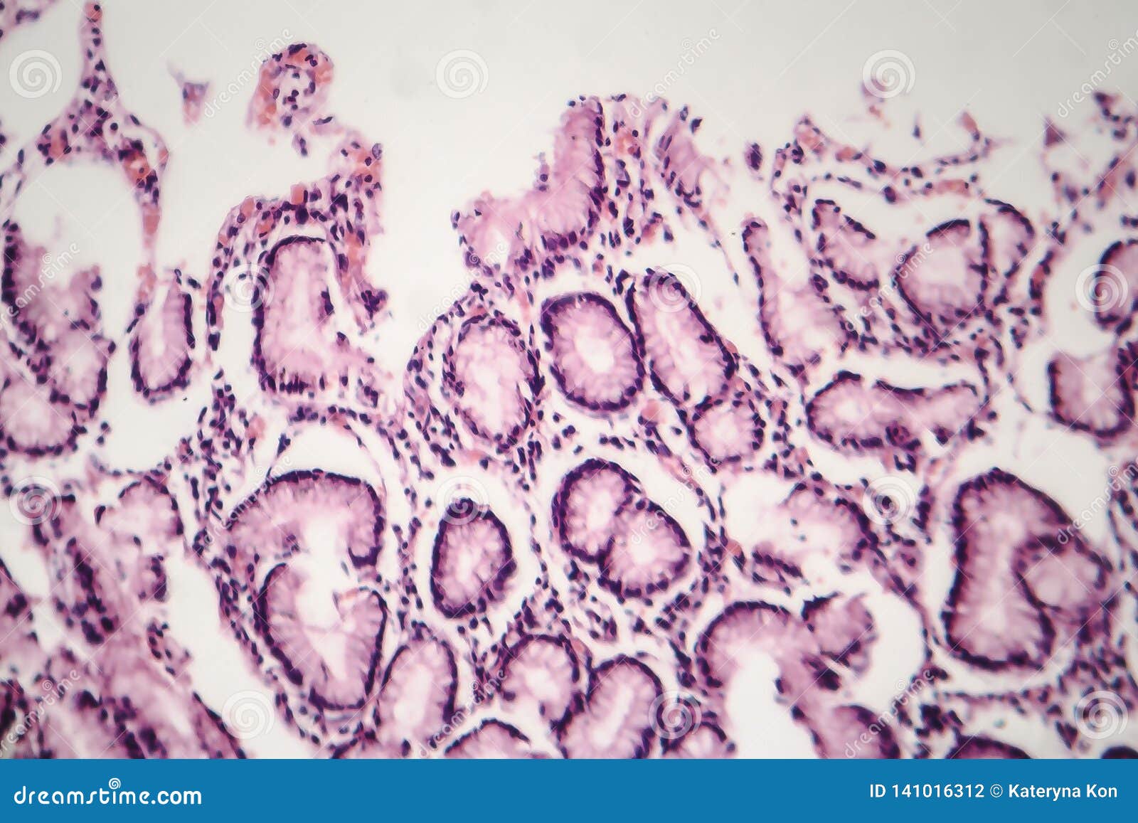 Chronic Atrophic Gastritis, Light Micrograph Stock Photo - Image of ...