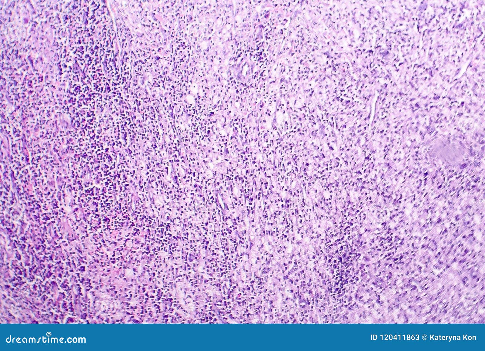 Histopathology of Chronic Cholecystitis Stock Image - Image of ischemia ...