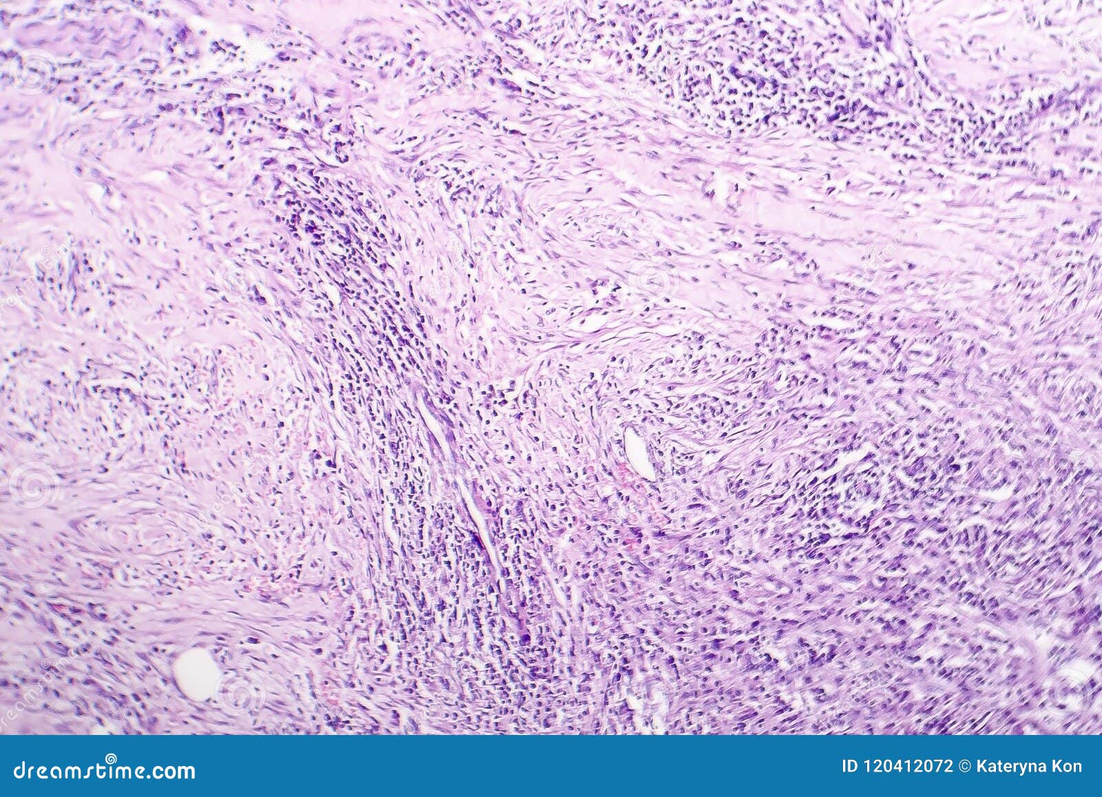 Pathology Outlines Eosinophilic Cholecystitis