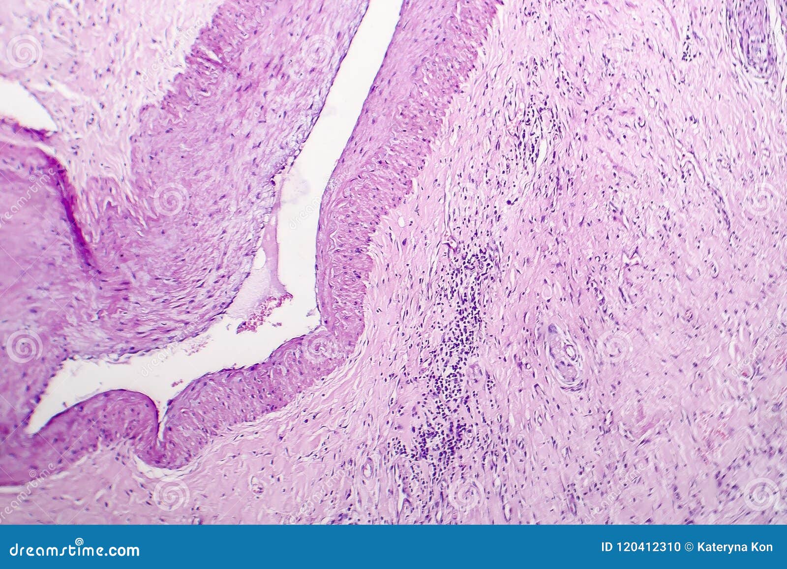 Pathology Outlines Eosinophilic Cholecystitis