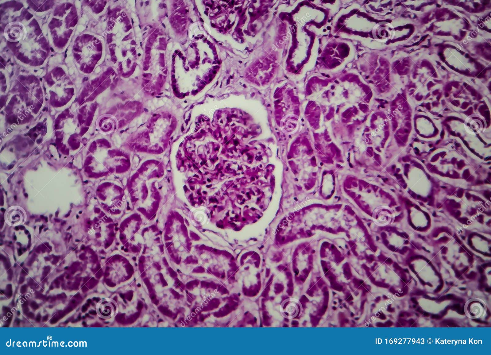 Diffuse Sclerosing Glomerulonephritis Stock Image - Image of kidney ...