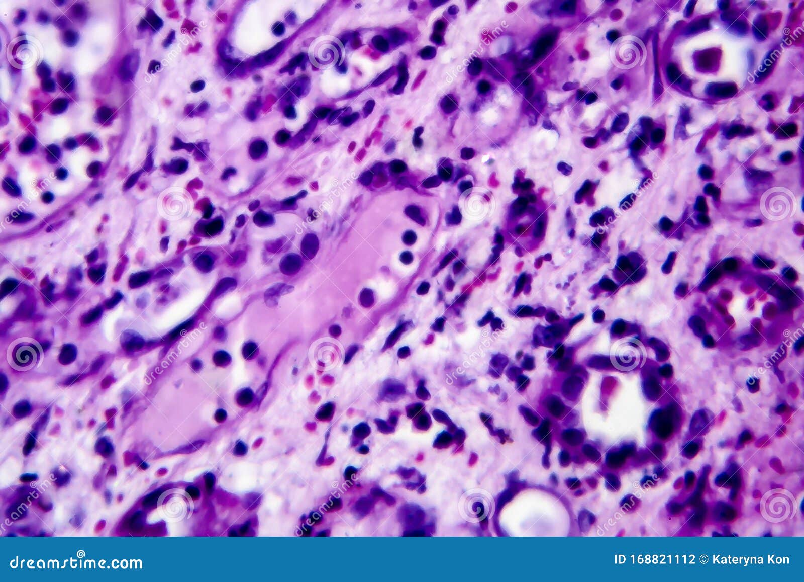 Histopathology of Interstitial Nephritis Stock Photo - Image of ...