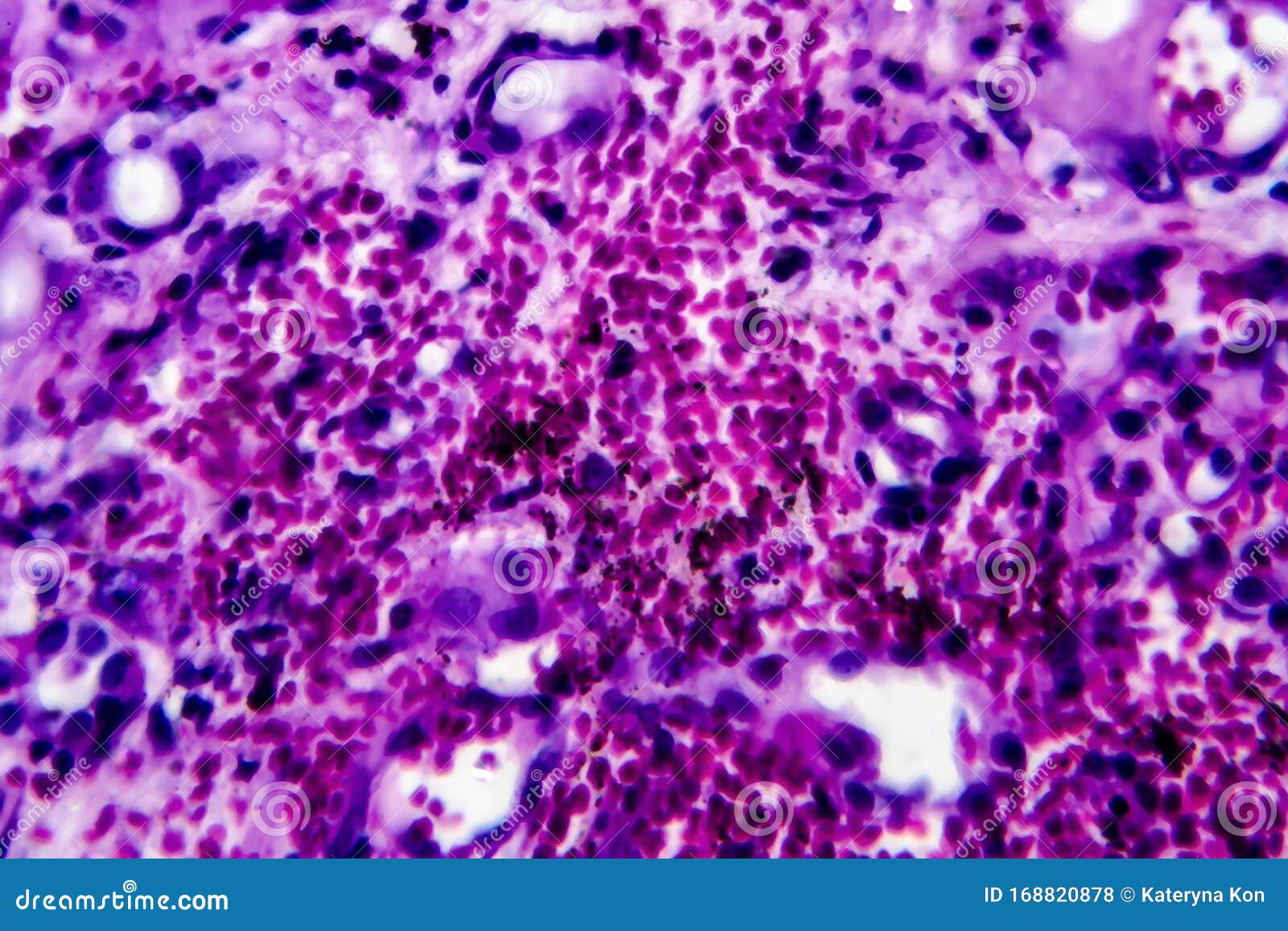Histopathology of Interstitial Nephritis Stock Photo - Image of stain ...