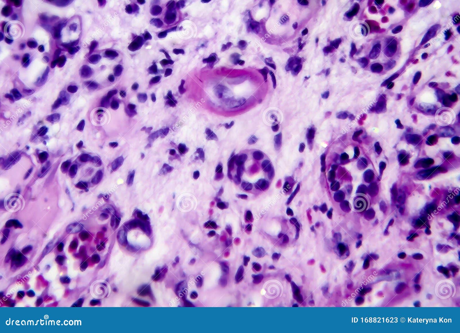 Histopathology of Interstitial Nephritis Stock Image - Image of tissue ...