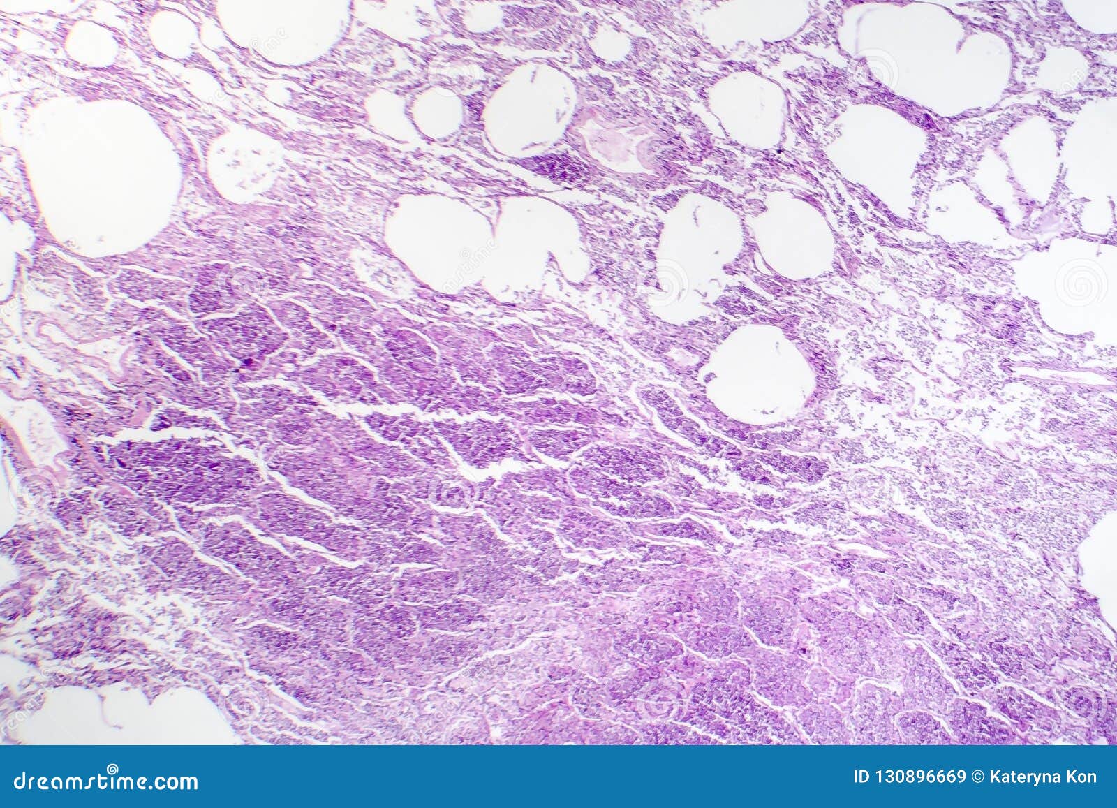 Histopathology of Interstitial Pneumonia Stock Image - Image of ...