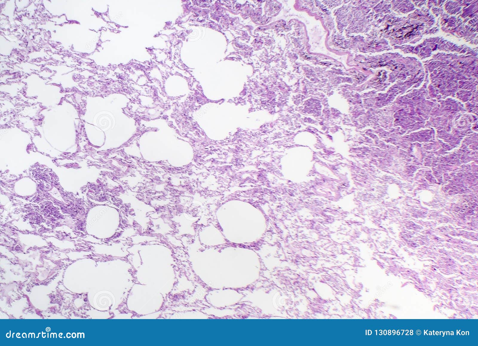 Histopathology of Interstitial Pneumonia Stock Photo - Image of diffuse ...