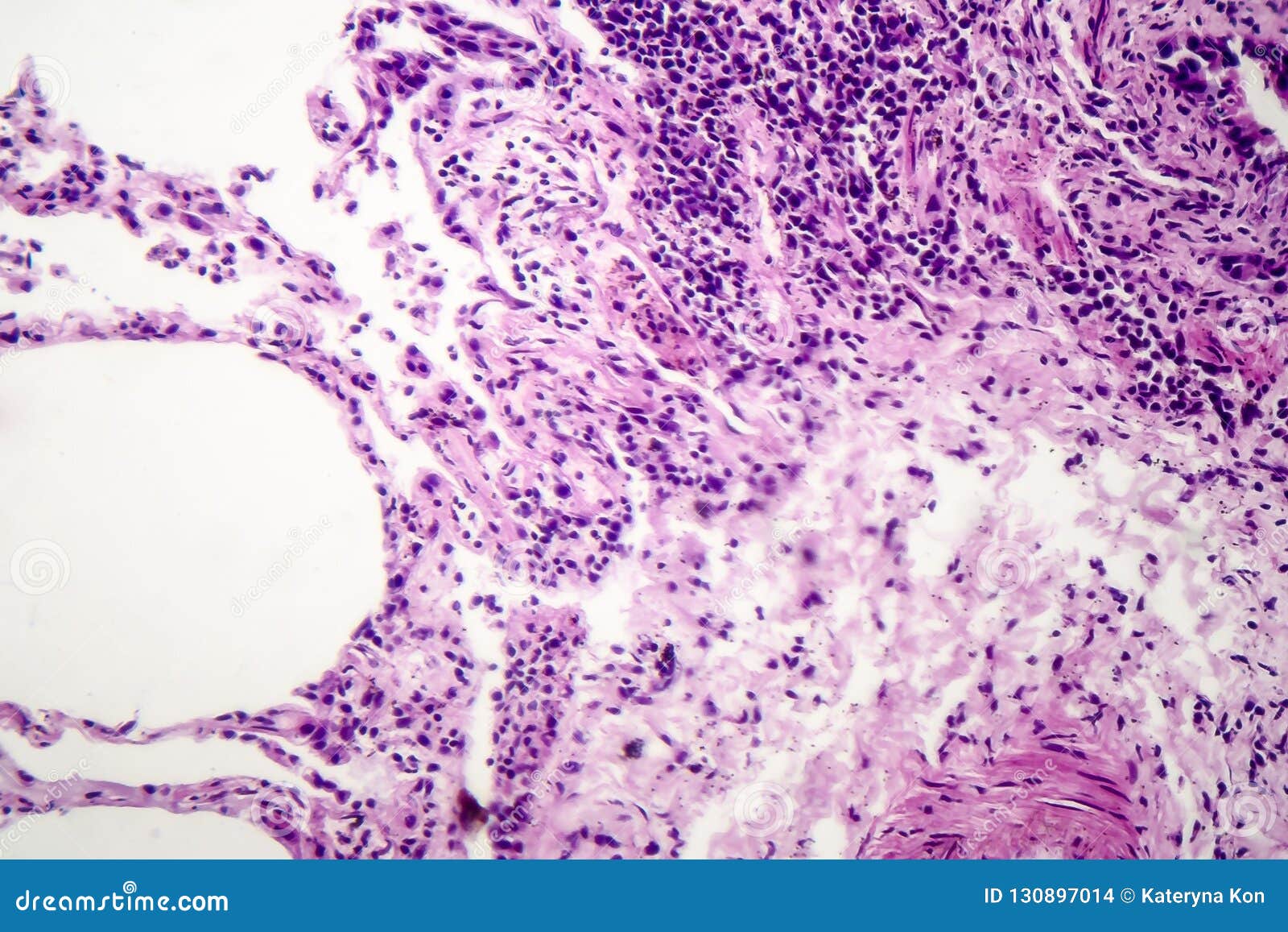 Histopathology of Interstitial Pneumonia Stock Photo - Image of ...