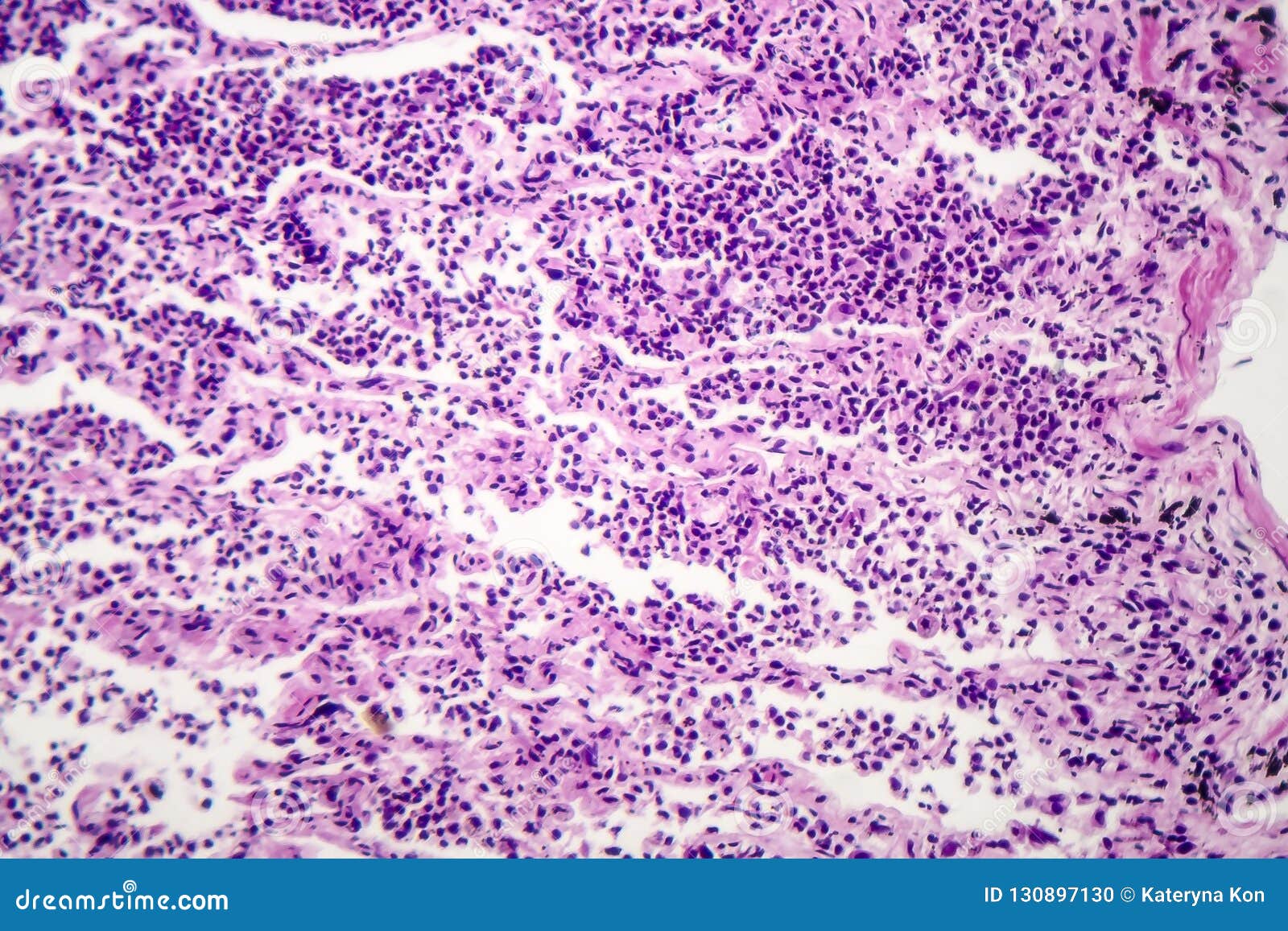 Histopathology of Interstitial Pneumonia Stock Photo - Image of ...