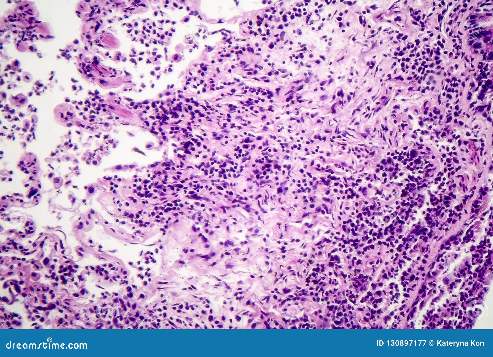 Histopathology of Interstitial Pneumonia Stock Image - Image of ...