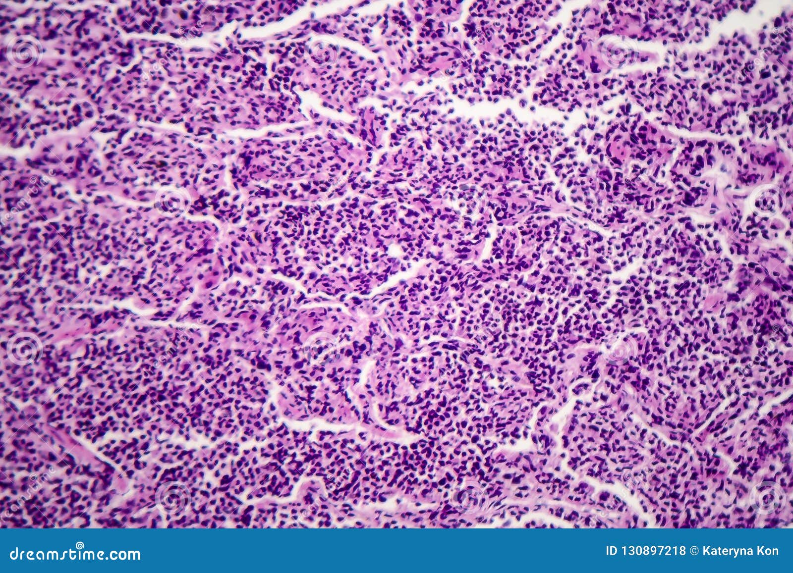 Histopathology of Interstitial Pneumonia Stock Photo - Image of ...