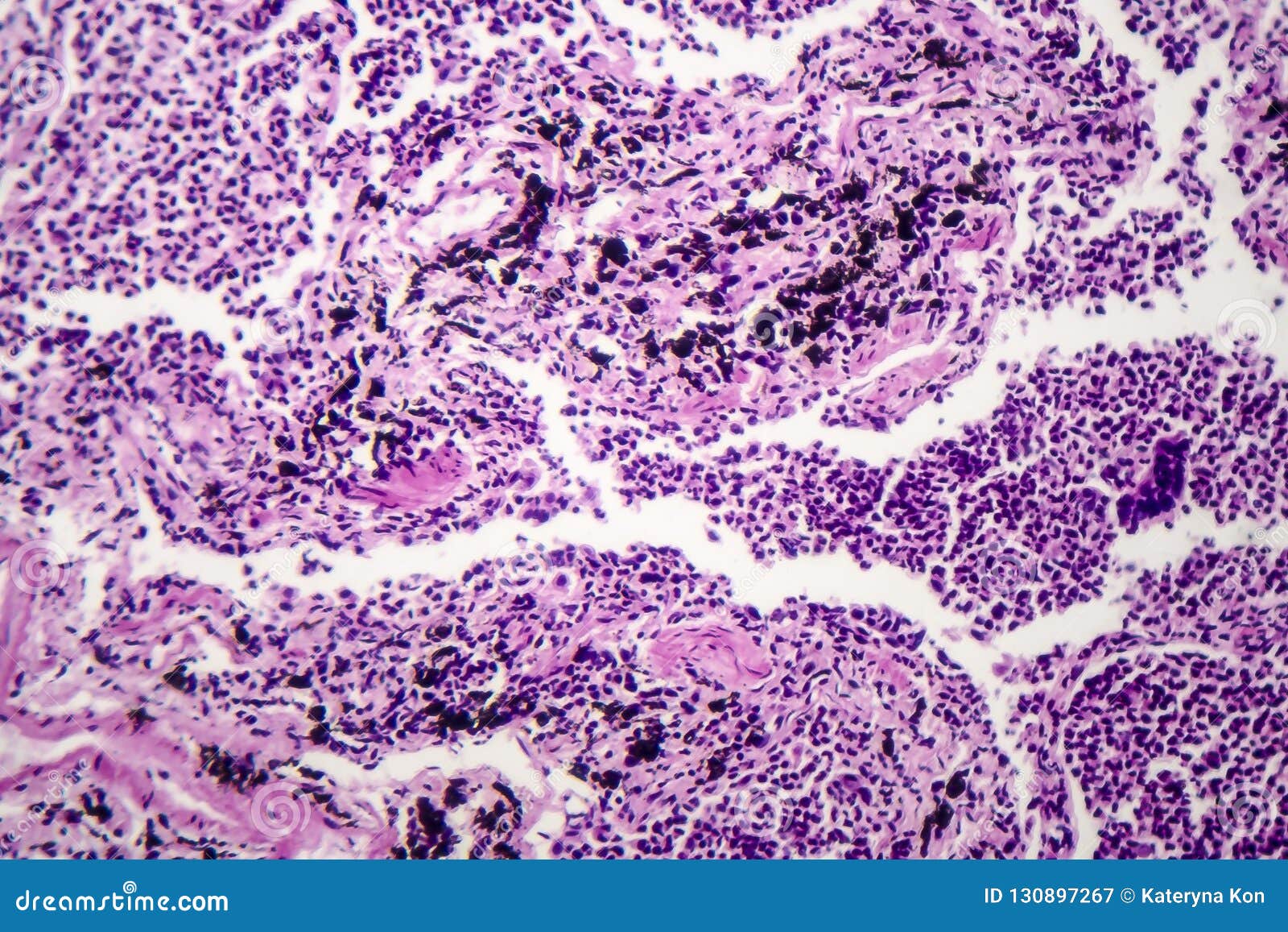 Histopathology of Interstitial Pneumonia Stock Image - Image of ...