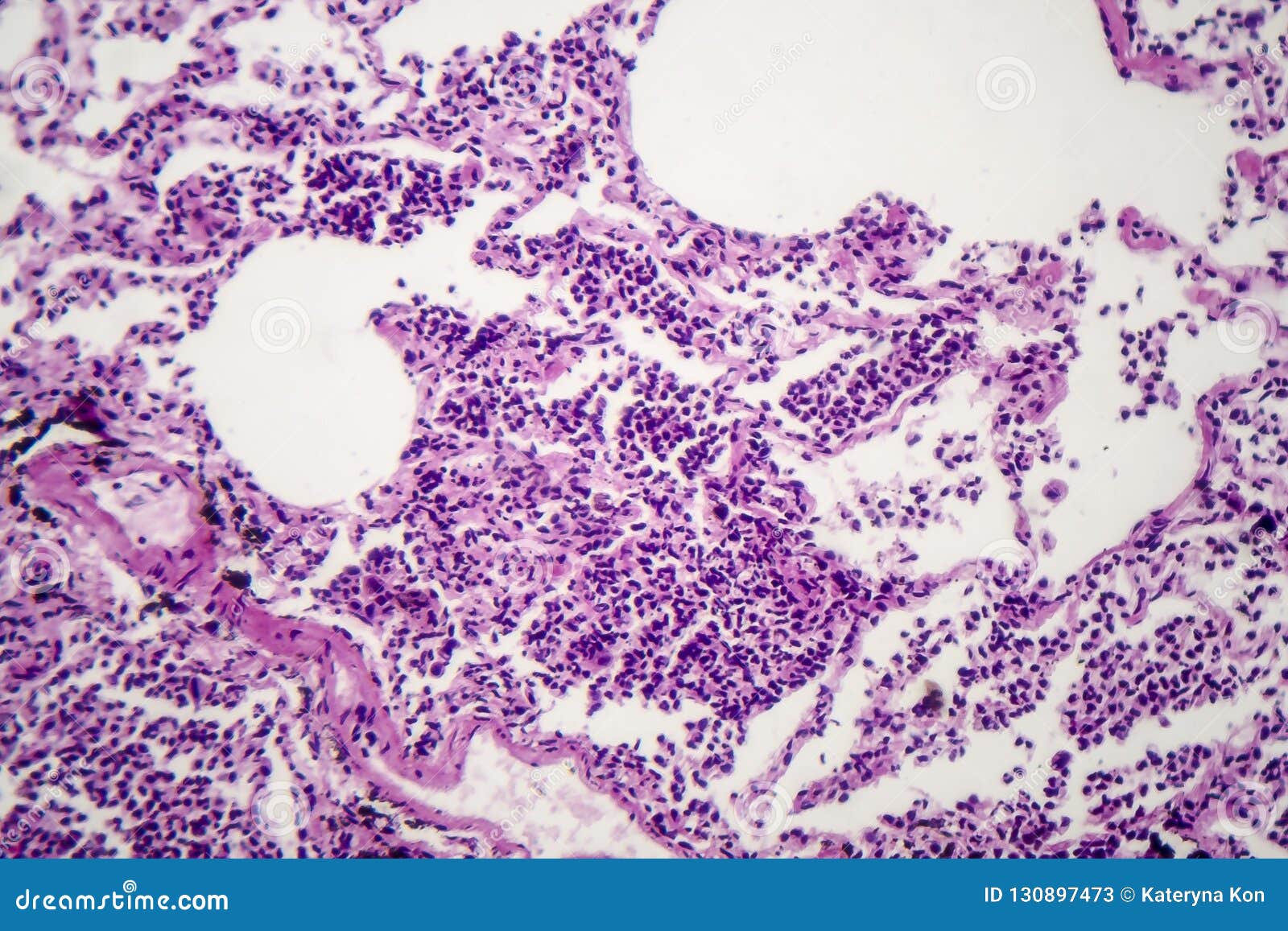 Interstitial Pneumonia Histology