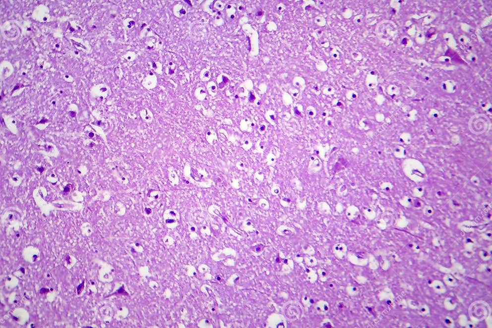 Histopathology of Japanese Encephalitis, Light Micrograph Stock Image ...