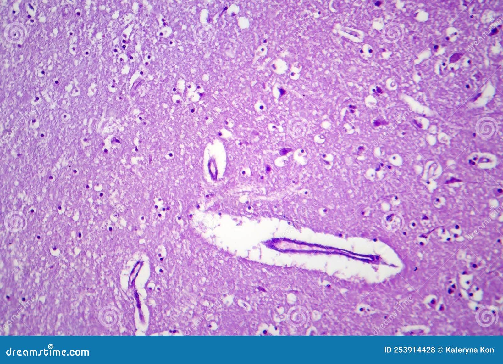 Histopathology of Japanese Encephalitis, Light Micrograph Stock Photo ...