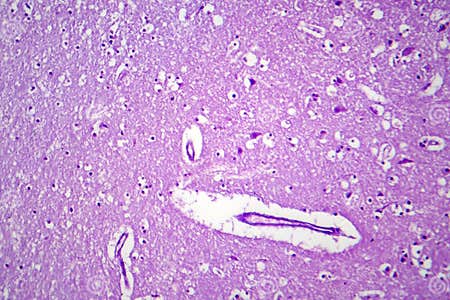 Histopathology of Japanese Encephalitis, Light Micrograph Stock Photo ...