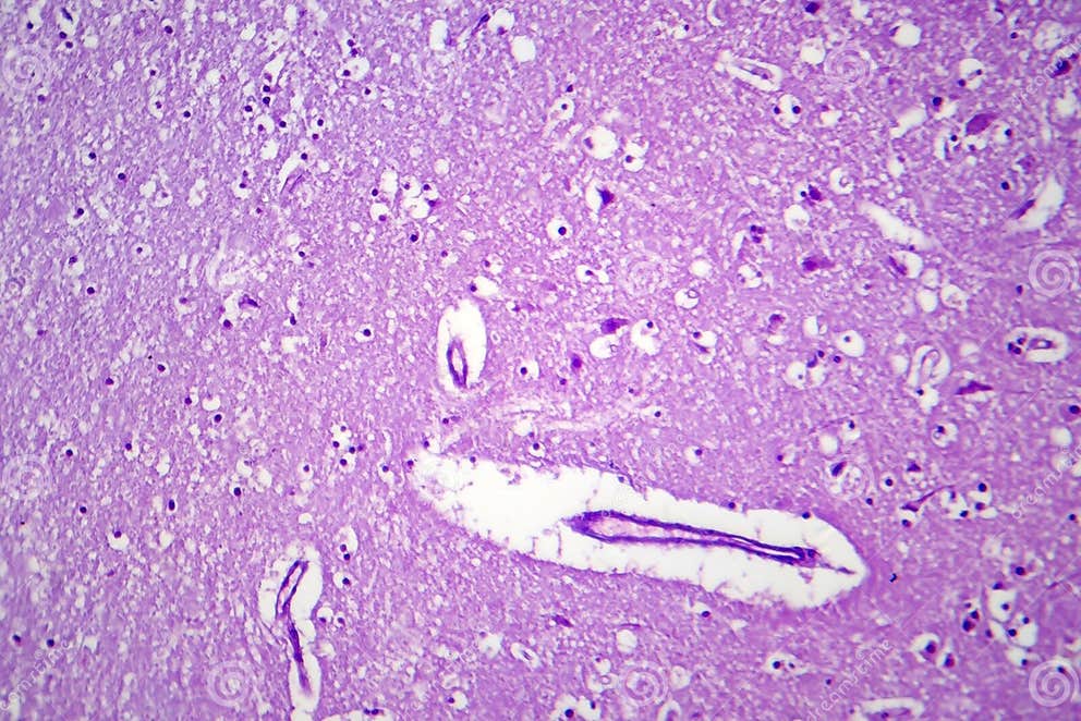 Histopathology of Japanese Encephalitis, Light Micrograph Stock Photo ...