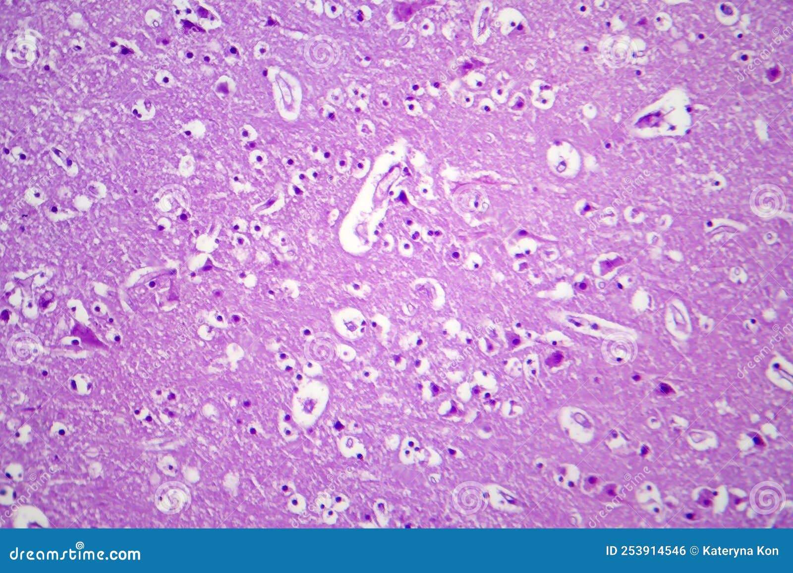 Histopathology of Japanese Encephalitis, Light Micrograph Stock Photo ...