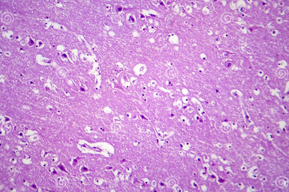 Histopathology of Japanese Encephalitis, Light Micrograph Stock Image ...