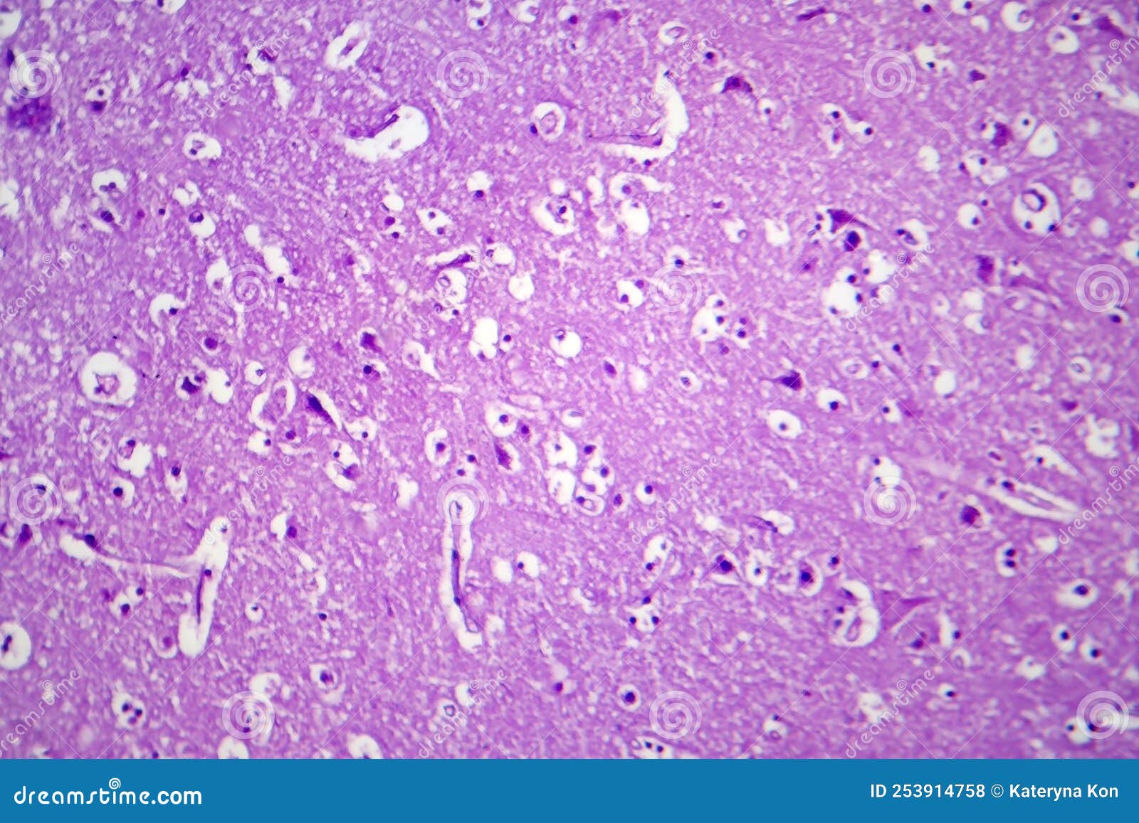 Histopathology of Japanese Encephalitis, Light Micrograph Stock Photo ...