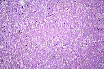 Histopathology of Japanese Encephalitis, Light Micrograph Stock Photo ...