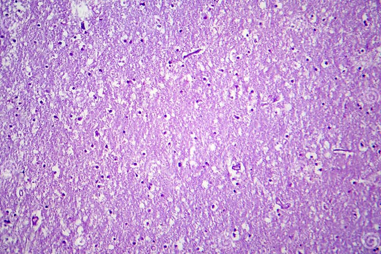Histopathology of Japanese Encephalitis, Light Micrograph Stock Photo ...