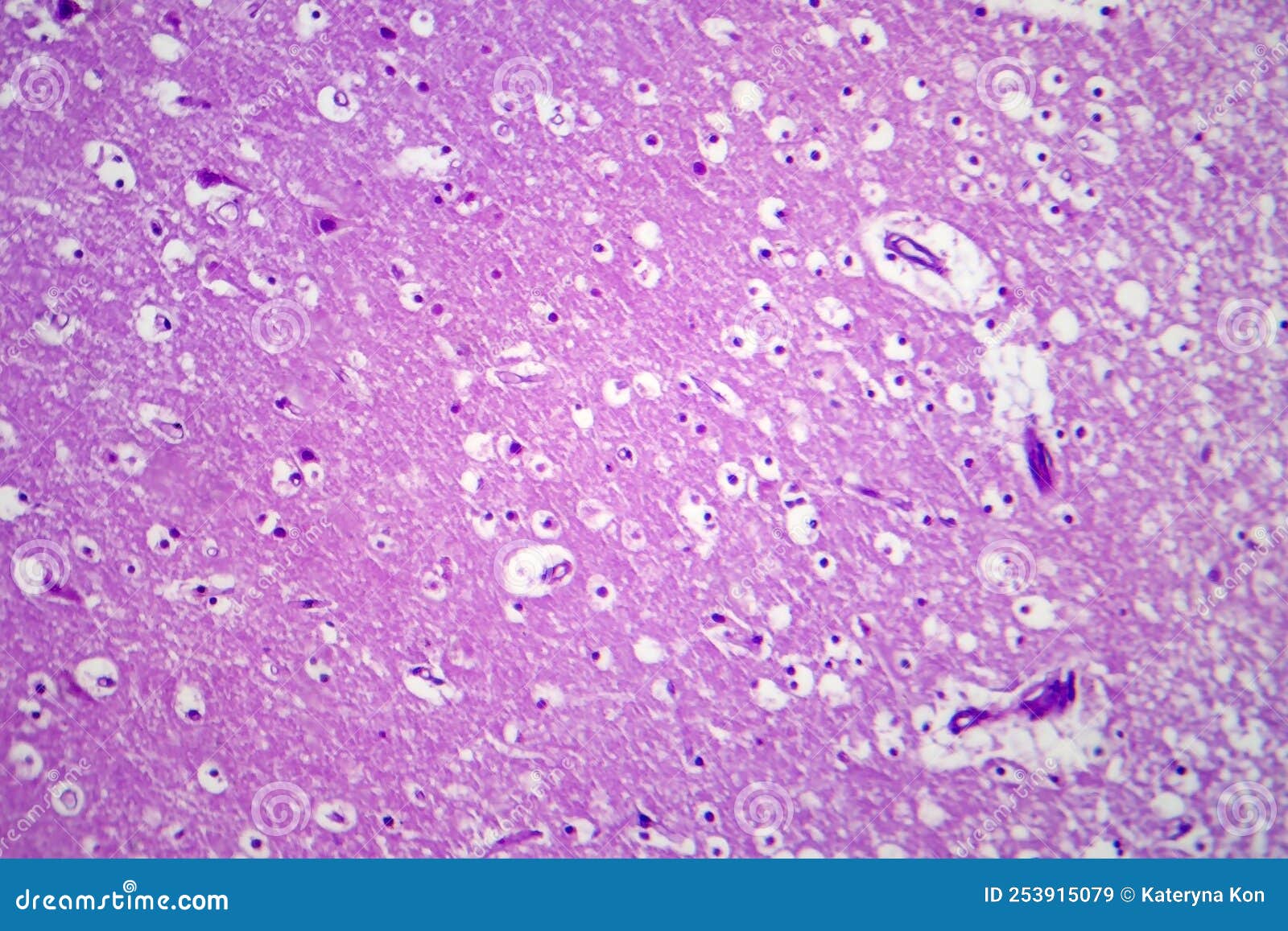 Histopathology Of Japanese Encephalitis, Light Micrograph Royalty-Free ... Histopathology Of Japanese Encephalitis, Light Micrograph Royalty-Free ...