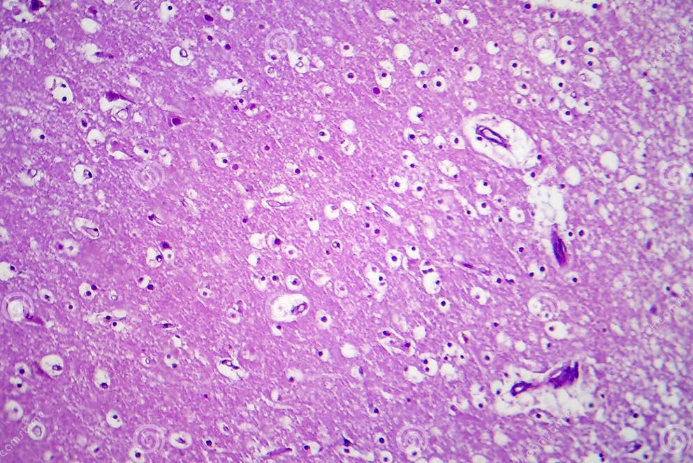 Histopathology of Japanese Encephalitis, Light Micrograph Stock Image ...