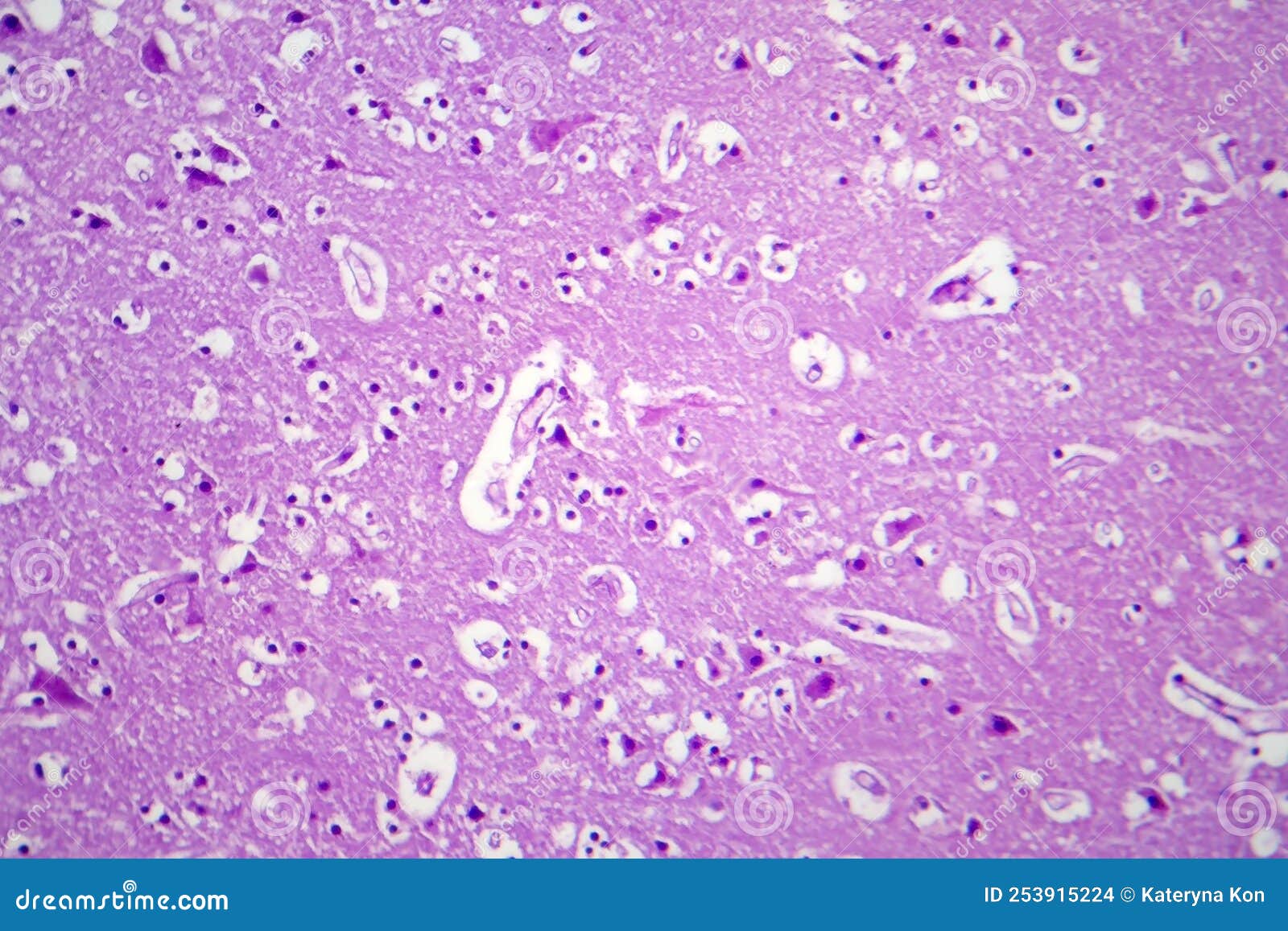 Histopathology of Japanese Encephalitis, Light Micrograph Stock Photo ...