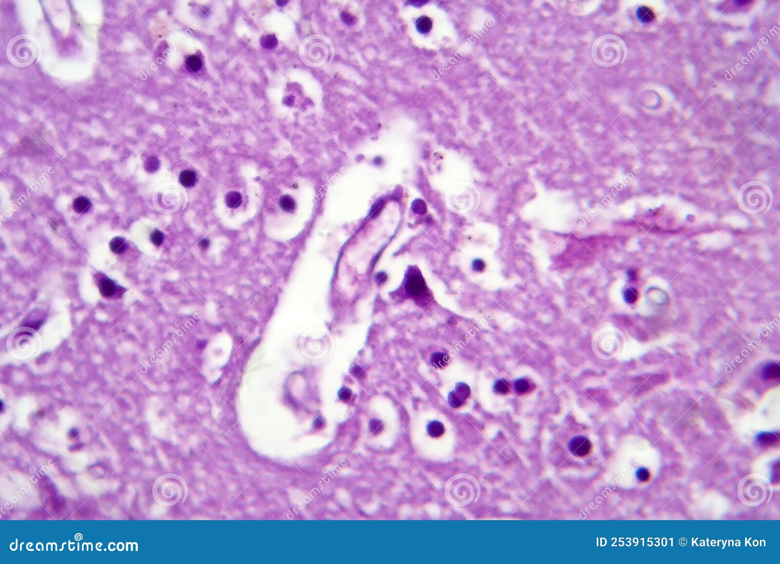 Histopathology Of Japanese Encephalitis, Light Micrograph Royalty-Free ... Histopathology Of Japanese Encephalitis, Light Micrograph Royalty-Free ...