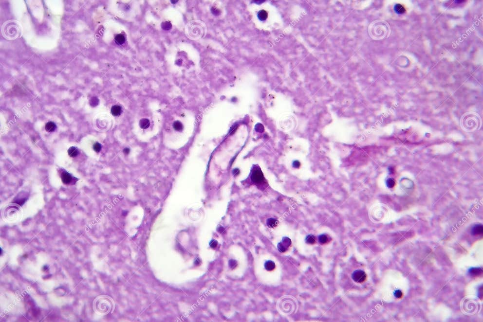 Histopathology of Japanese Encephalitis, Light Micrograph Stock Image ...