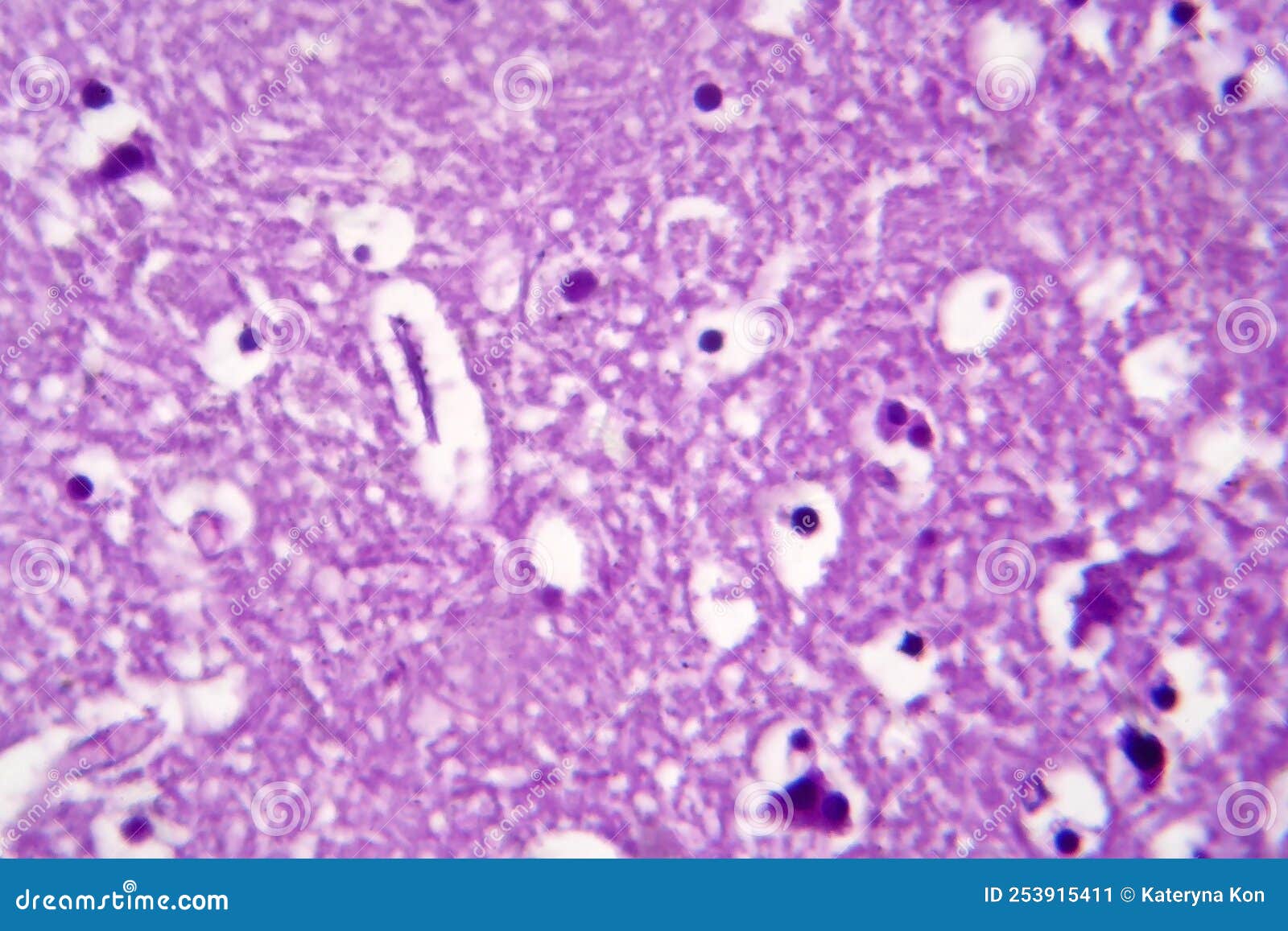 Histopathology of Japanese Encephalitis, Light Micrograph Stock Image ...