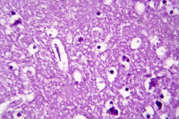 Histopathology of Japanese Encephalitis, Light Micrograph Stock Image ...