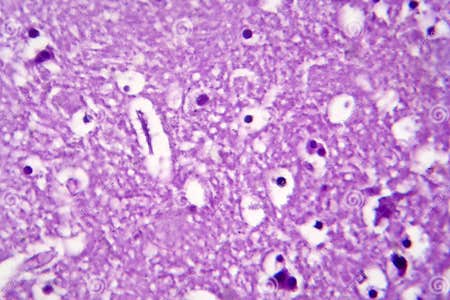 Histopathology of Japanese Encephalitis, Light Micrograph Stock Image ...