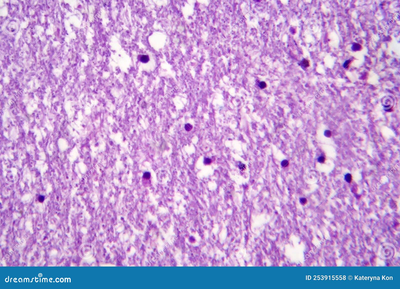 Histopathology Of Japanese Encephalitis, Light Micrograph Stock ... Histopathology Of Japanese Encephalitis, Light Micrograph Stock ...