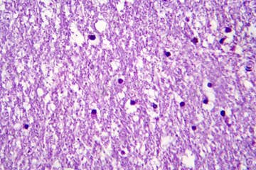 Histopathology of Japanese Encephalitis, Light Micrograph Stock Photo ...