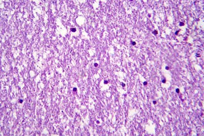 Histopathology of Japanese Encephalitis, Light Micrograph Stock Photo ...