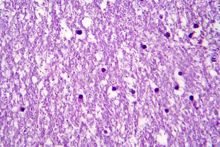 Histopathology of Japanese Encephalitis, Light Micrograph Stock Photo ...