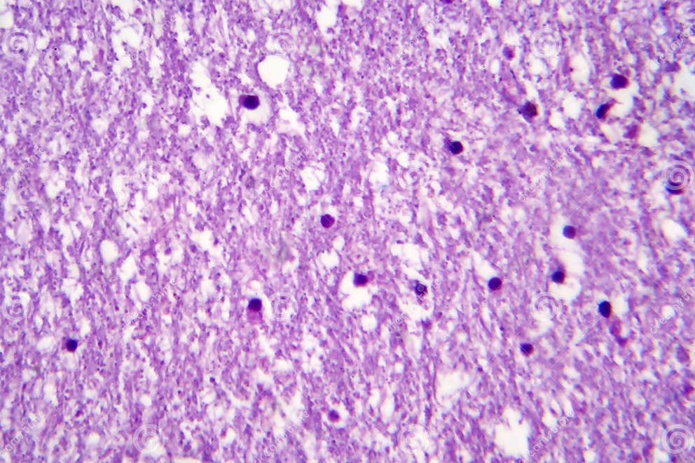 Histopathology of Japanese Encephalitis, Light Micrograph Stock Photo ...