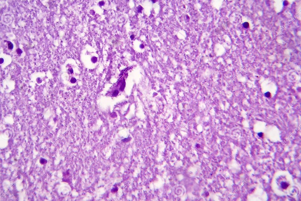 Histopathology of Japanese Encephalitis, Light Micrograph Stock Photo ...