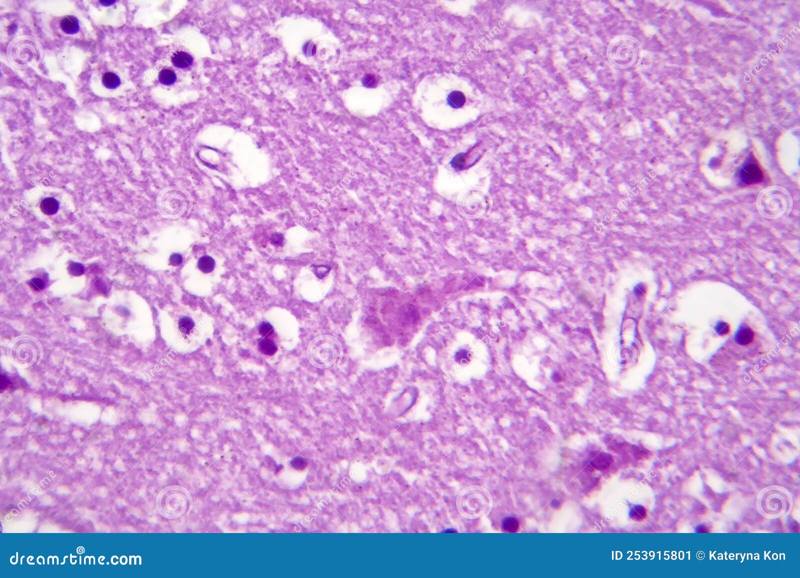 Histopathology of Japanese Encephalitis, Light Micrograph Stock Image ...