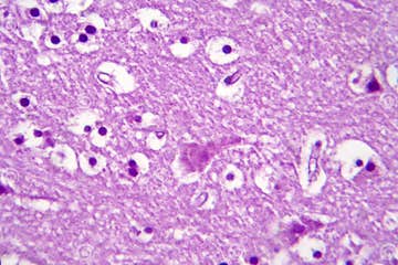 Histopathology of Japanese Encephalitis, Light Micrograph Stock Image ...