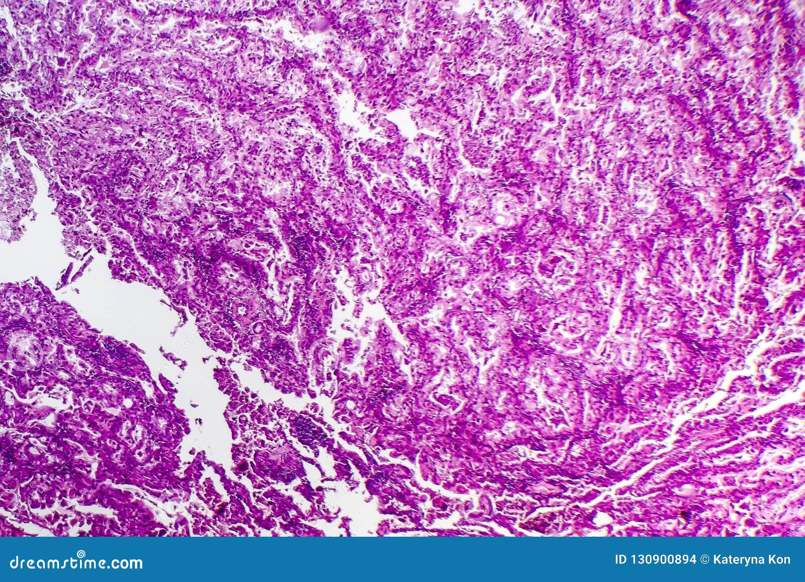 Histopathology of Lung Cancer Stock Photo - Image of medical, neoplasia ...