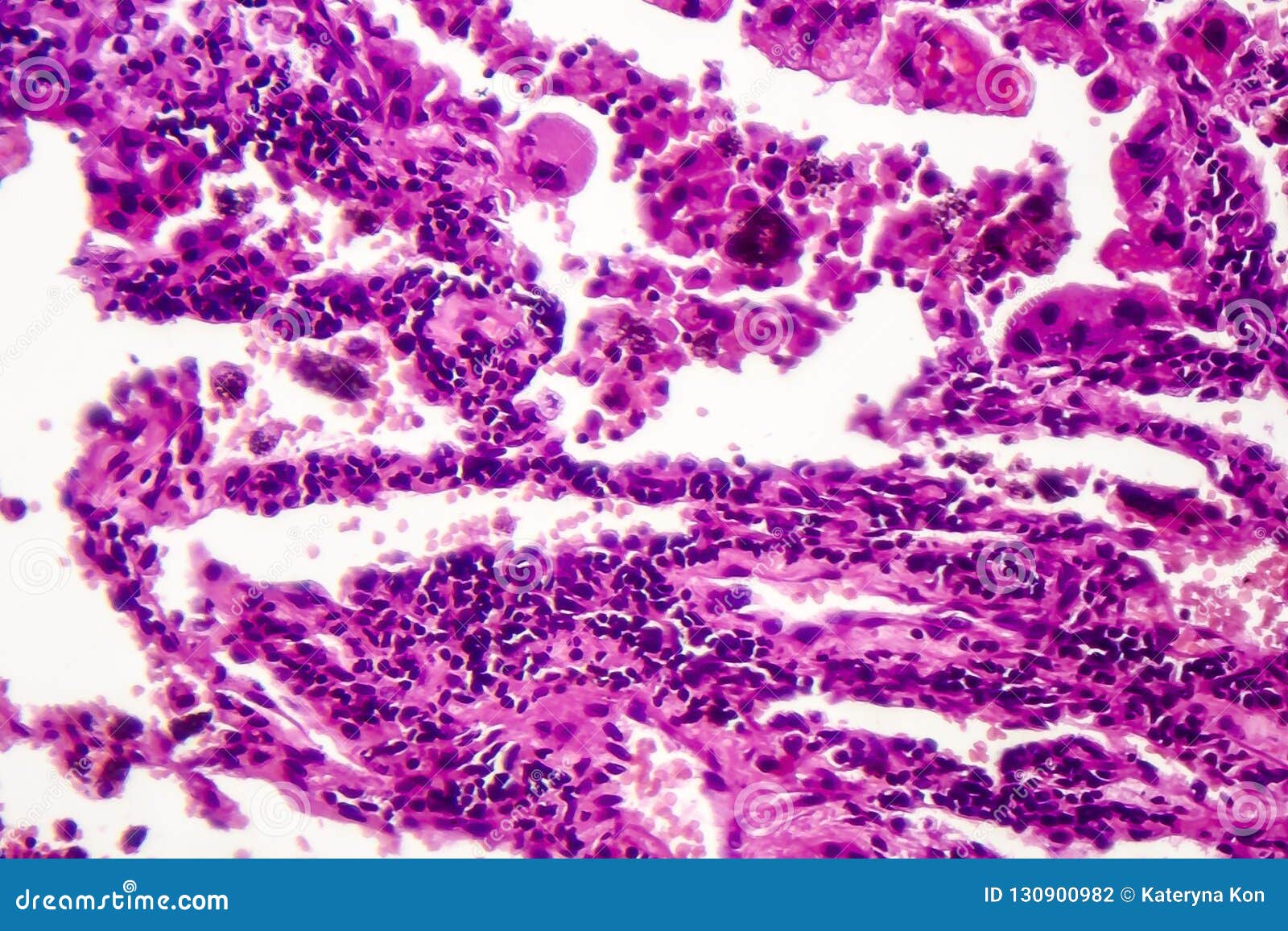 Histopathology of Lung Cancer Stock Photo - Image of microscope, lung ...