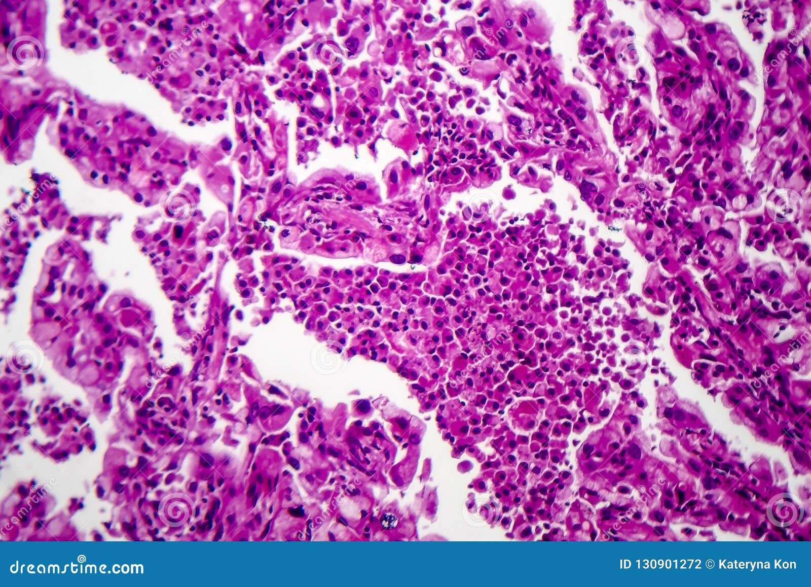 Histopathology of Lung Cancer Stock Photo - Image of medicine, neoplasm ...