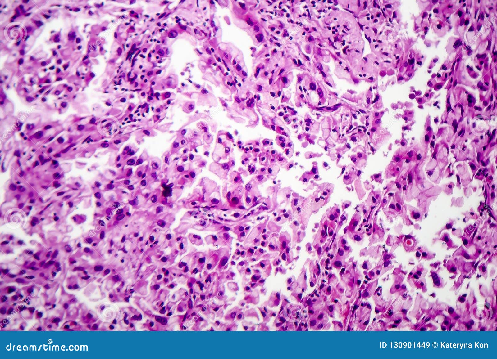 Histopathology of Lung Cancer Stock Image - Image of cancer, microscope ...